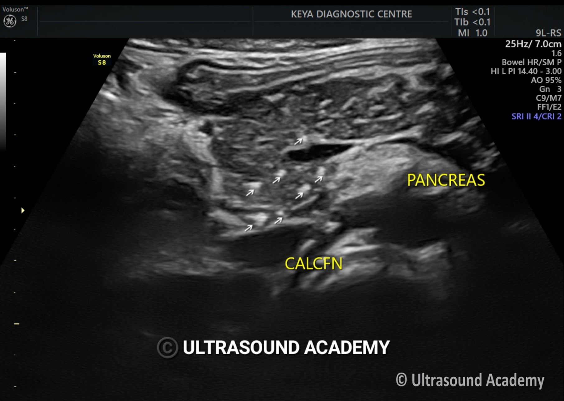CHRONIC PANCREATITIS IN CHILD – Case By Dr. Nitin Jadhav