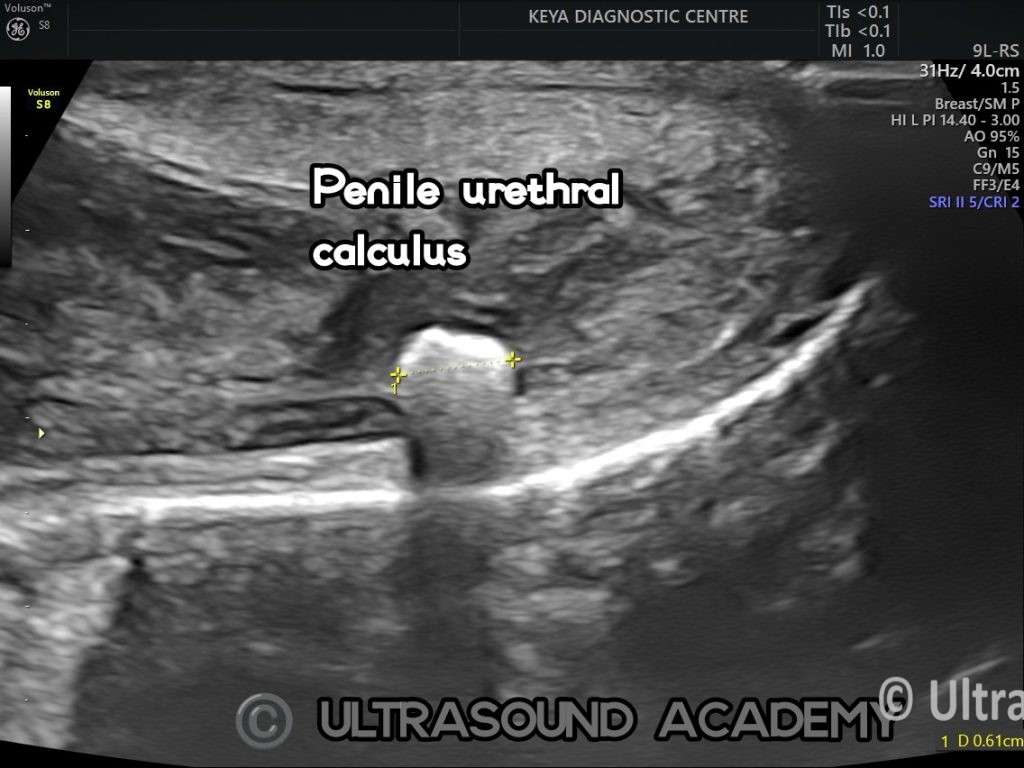 PENILE URETHRAL CALCULUS – Case By Dr. Nitin Jadhav