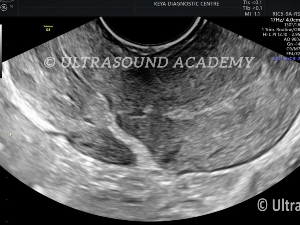 ACUTE UTERINE PERFORATION – Case By Dr. Nitin Jadhav